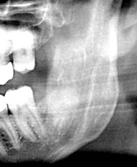 Kieferzysten Zysten Zystenhöhle Knochen Hohlraum gutartig - Zahnarzt Dr ...